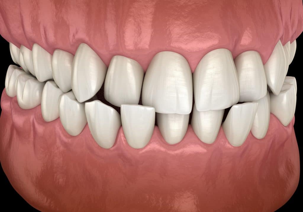 Everything You Need to Know About Crossbites and How We Correct Them ...
